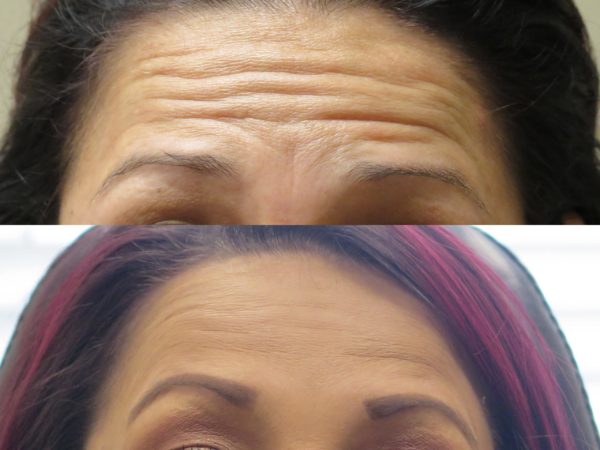 Qué hacer después del Botox en la frente: una guía completa - Utah ...
