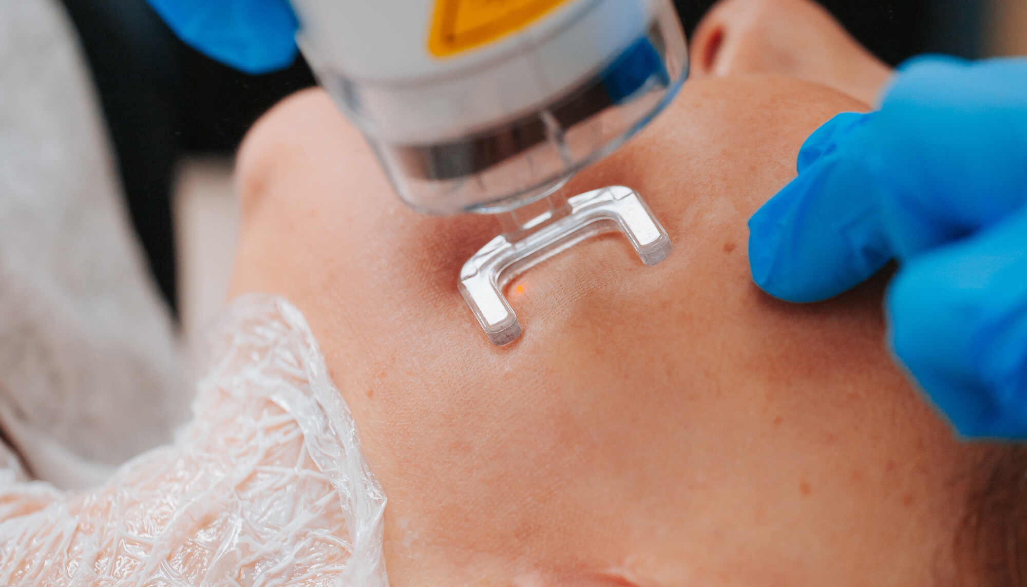 Candidatos ideales para el lifting facial frente a los tratamientos con ...
