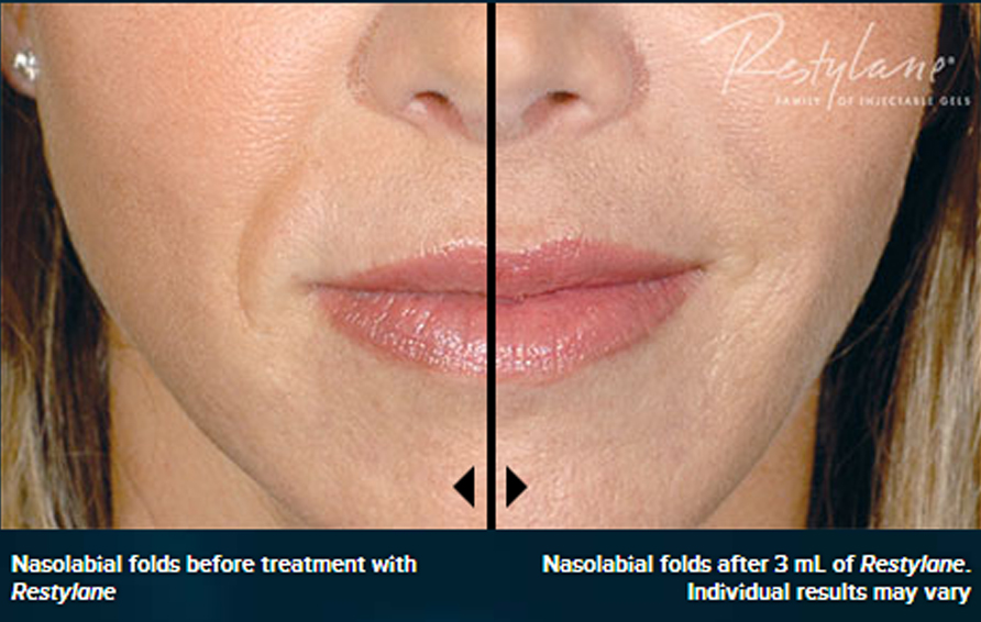 Restylane® | Utah Facial Plastics