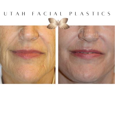 Smoker Lips Before And After | Lipstutorial.org