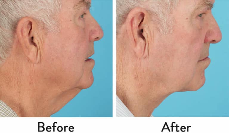 Neck Lift Salt Lake City, UT - Direct Neck Lift in Utah