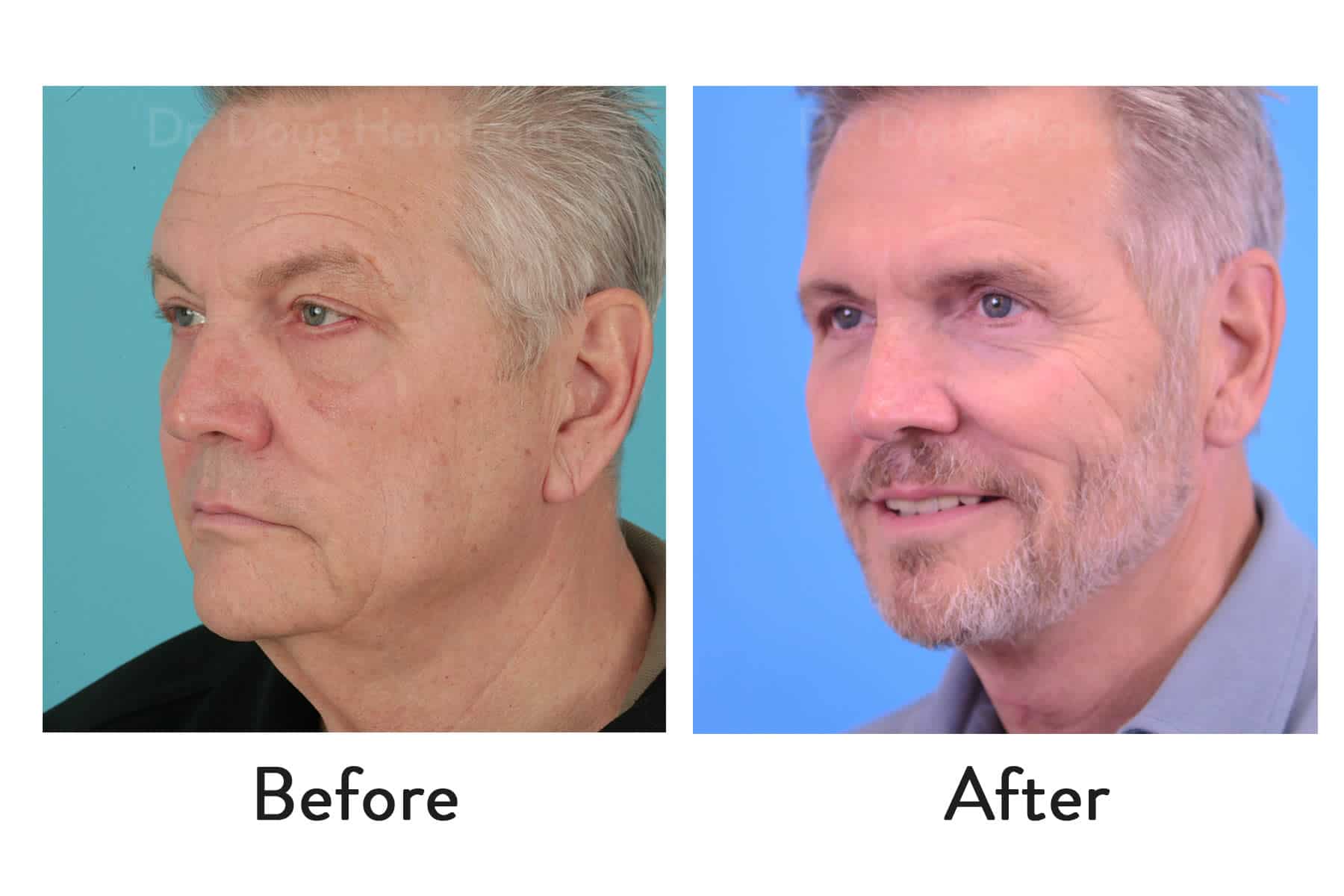Direct Necklift | Dr. Douglas Henstrom | Utah Facial Plastics