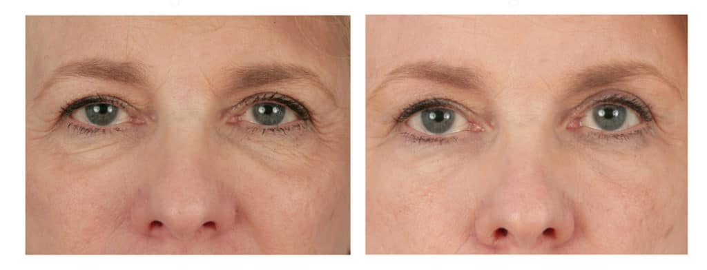 Under Eye Fillers Salt Lake City UT - Under Eye Wrinkle Treatment