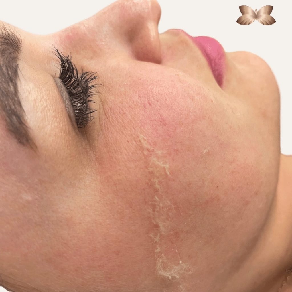 Dermaplane Facial, Dermplaning - Utah Facial Plastics