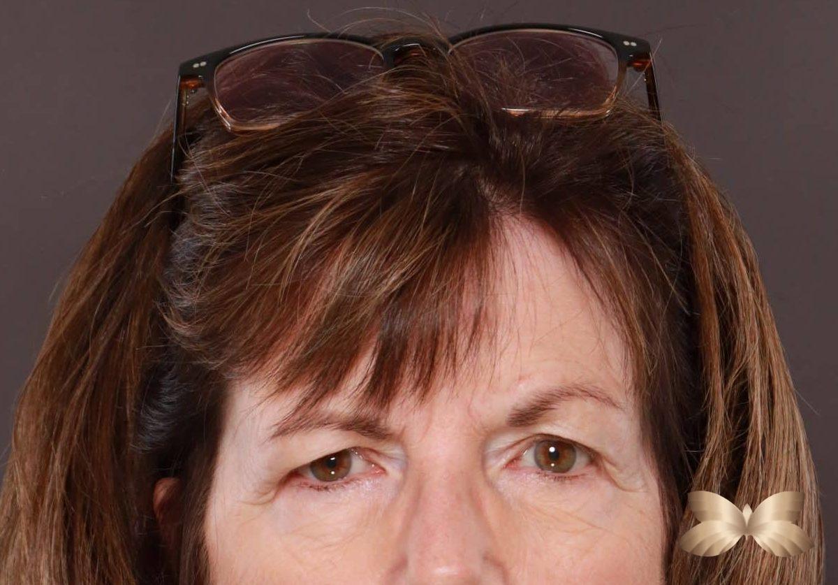 Eyelid Lift (Upper) Archives - Utah Facial Plastics