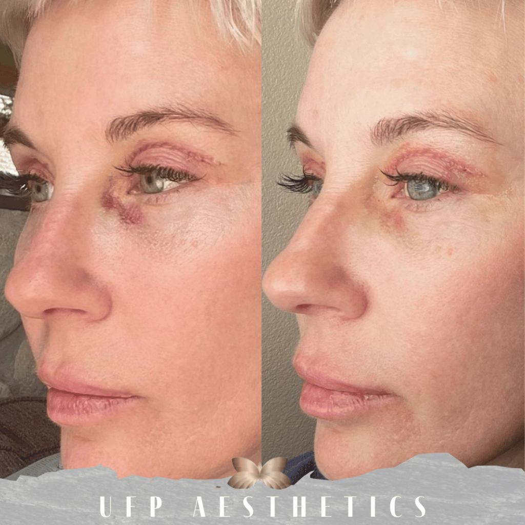 Plastic Surgery Recovery - Utah Facial Plastics