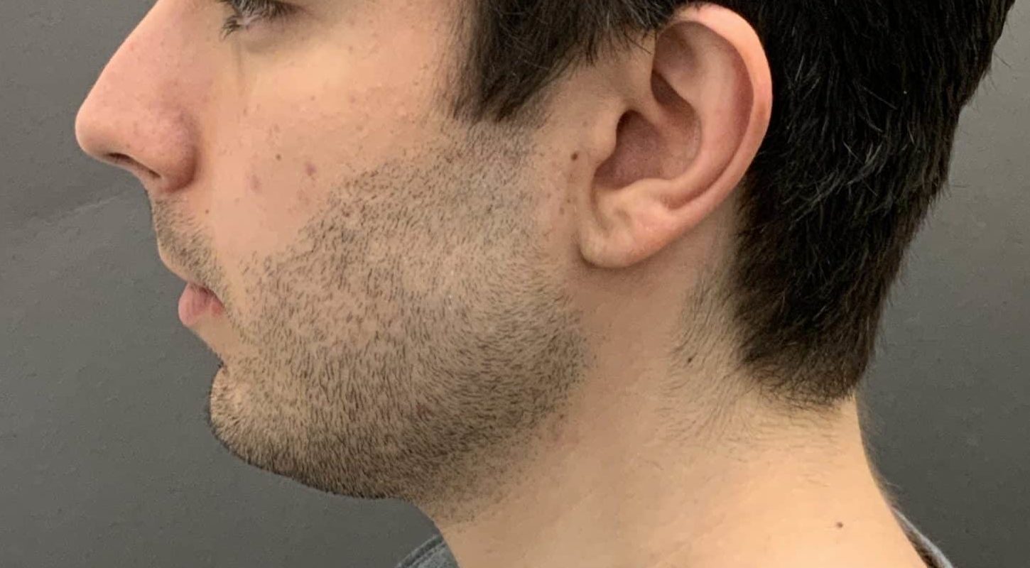 Kybella Before & After Photos | 995 Case: 0494 - Utah Facial Plastics