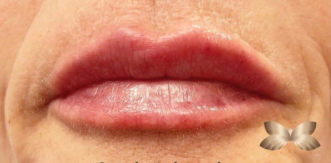 Lip Augmentation by: Lauren Case: 21402 - Utah Facial Plastics