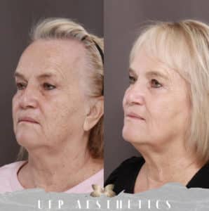 Contour TRL Laser Salt Lake City UT - Before & After, Recovery