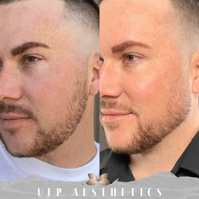 Juvederm Volux: A New Filler For a More Defined Jawline