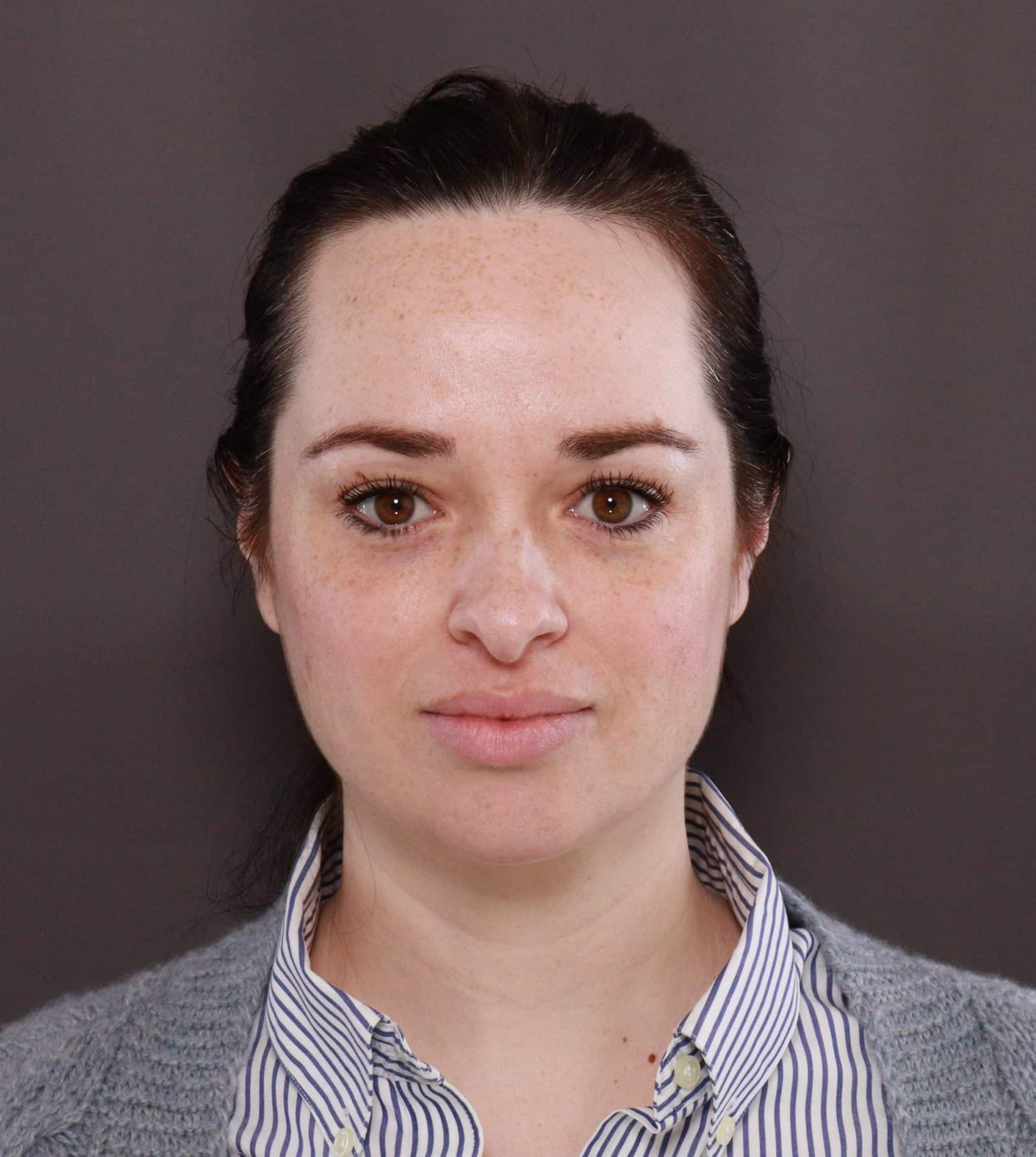 Face Archives - Utah Facial Plastics