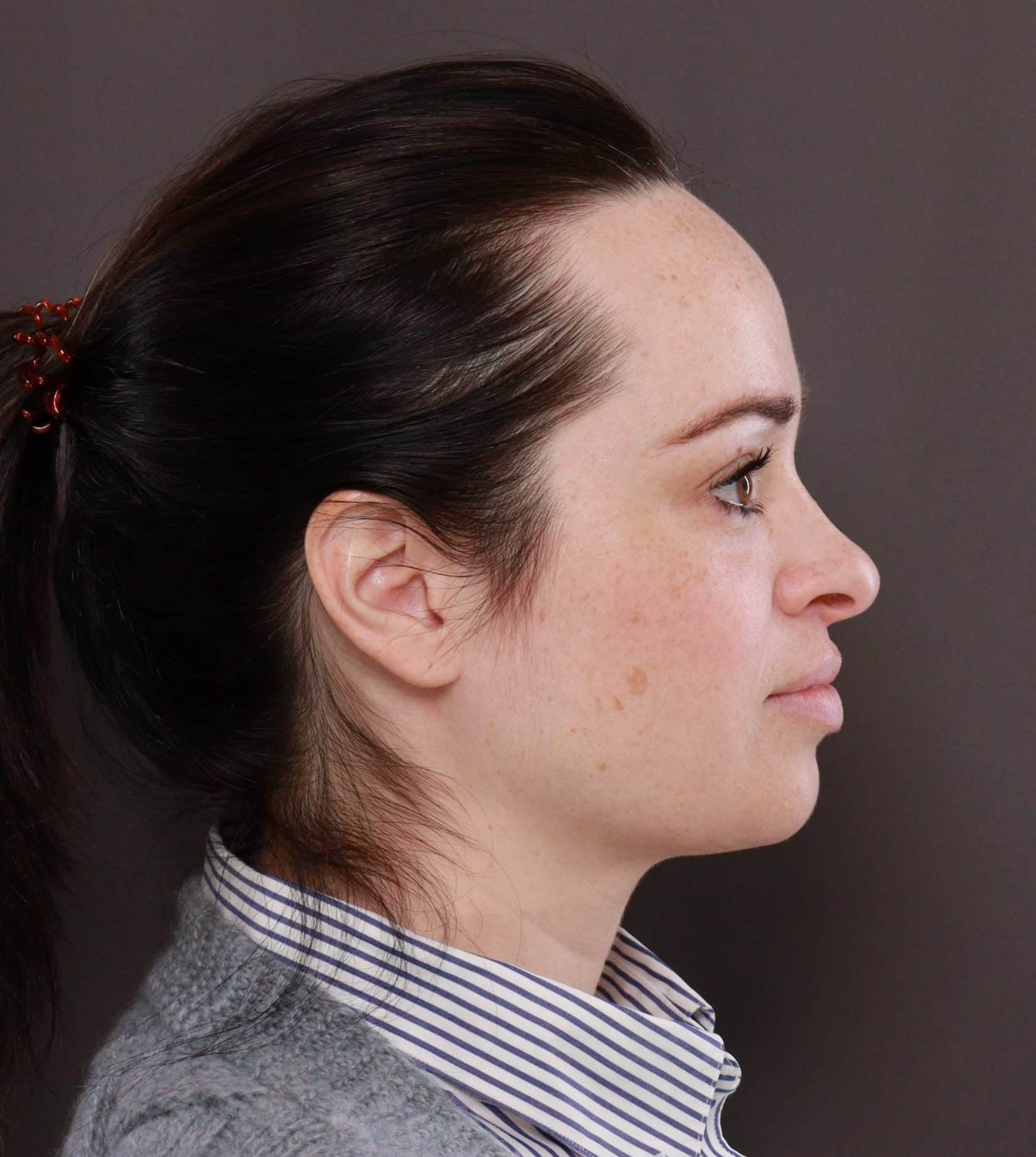 Forehead Reduction by Dr. Thompson - Utah Facial Plastics