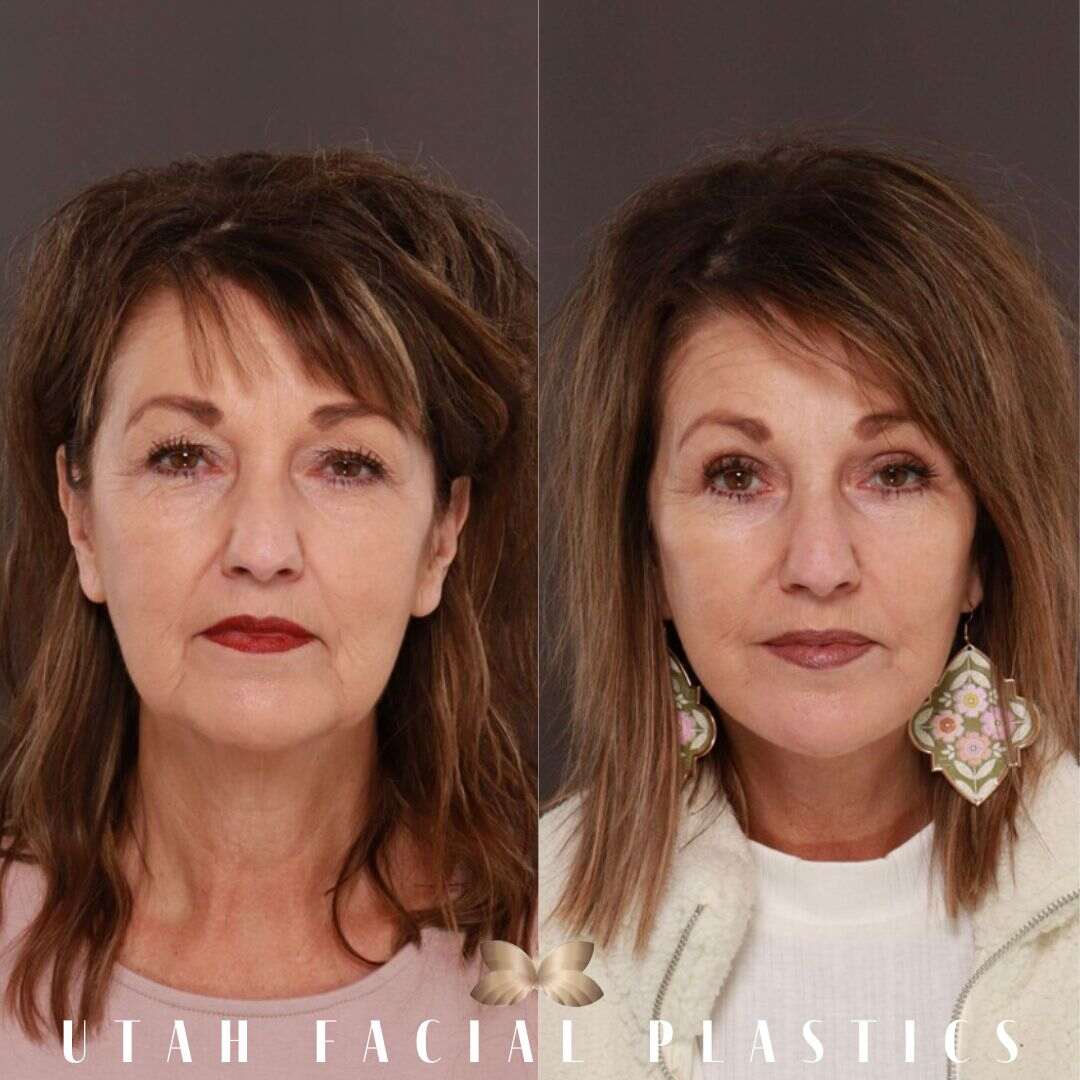 Facelifts Logan, UT - Utah Facial Plastics