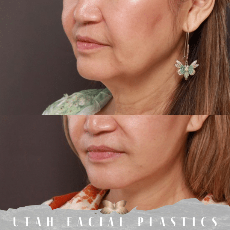 Buccal Fat Removal Salt Lake City - Utah Facial Plastics