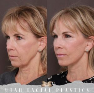 Forehead Lift Salt Lake City - Brow Lift in Utah