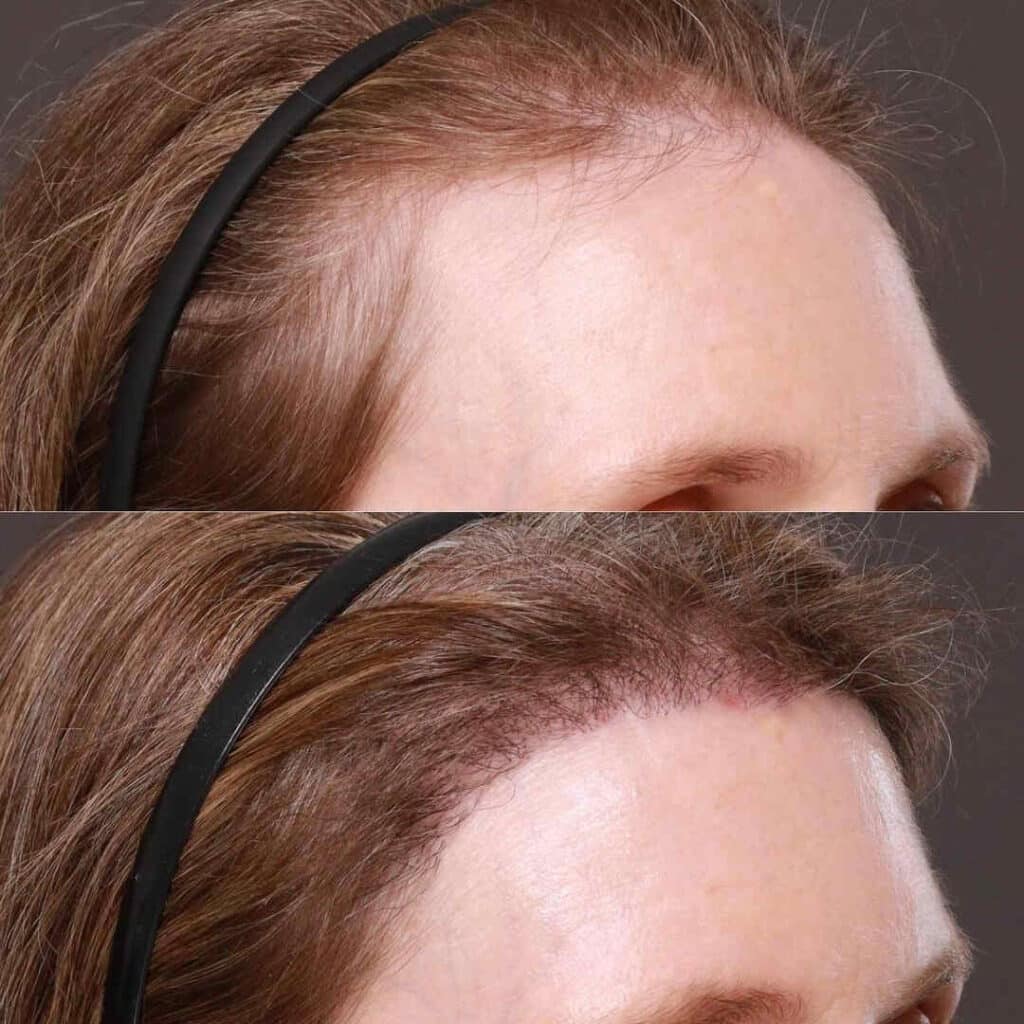 Non-Surgical Forehead Beauty Treatments - Utah Facial Plastics