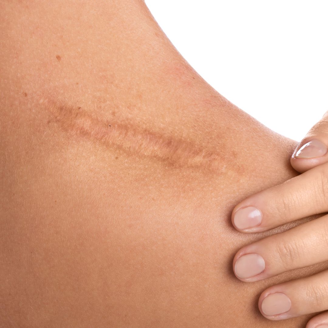 Scar Revision Surgery: Understanding the Procedure and Benefits - Utah ...