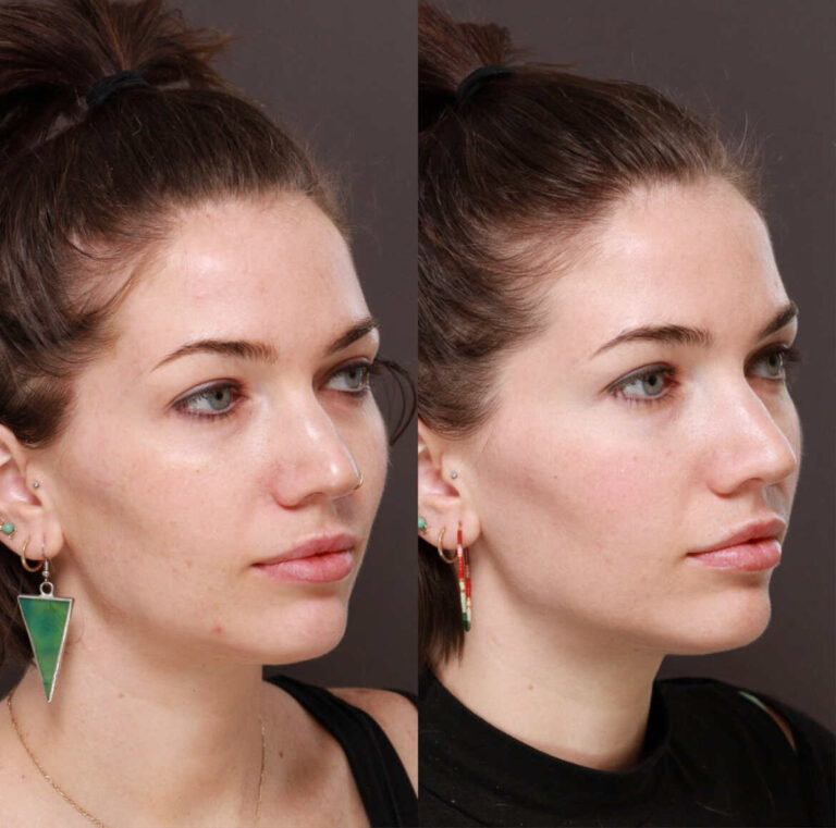 Plastic Surgery Blog | Utah Facial Plastics | Layton & Draper Utah