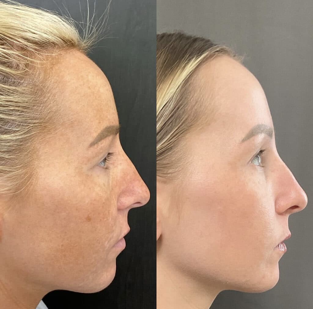 How Many Moxi Treatments Do I Need? A Guide - Utah Facial Plastics