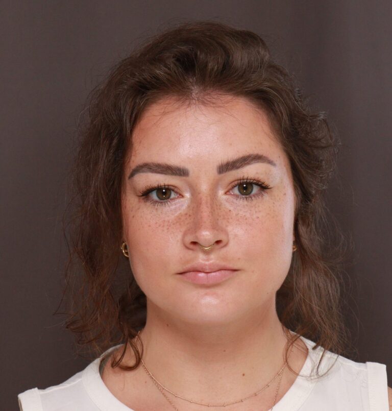 Deep Neck Contouring with Chin Implant by Dr. Manning - Utah Facial ...