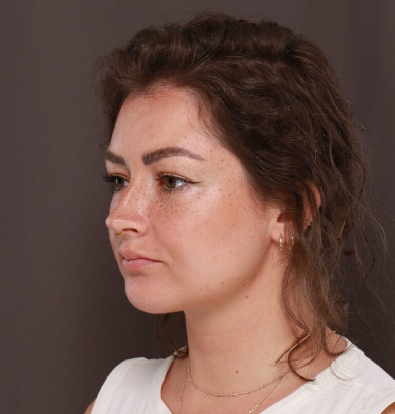 Deep Neck Contouring with Chin Implant by Dr. Manning - Utah Facial ...