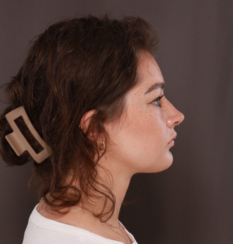 Deep Neck Contouring with Chin Implant by Dr. Manning - Utah Facial ...