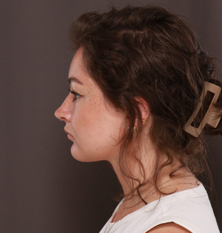 Deep Neck Contouring with Chin Implant by Dr. Manning - Utah Facial ...