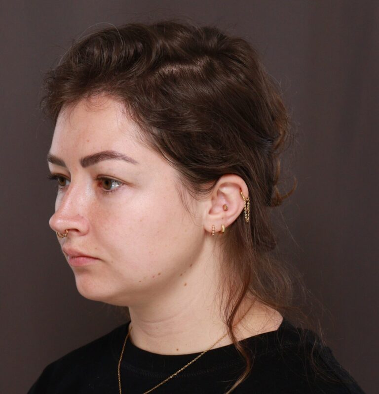 Deep Neck Contouring with Chin Implant by Dr. Manning - Utah Facial ...