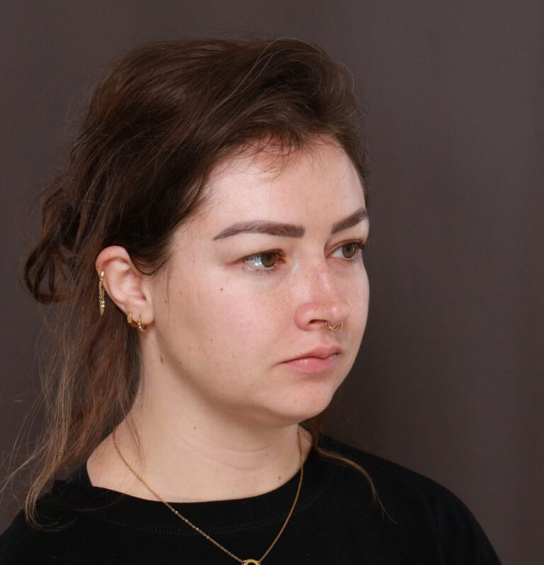 Deep Neck Contouring with Chin Implant by Dr. Manning - Utah Facial ...