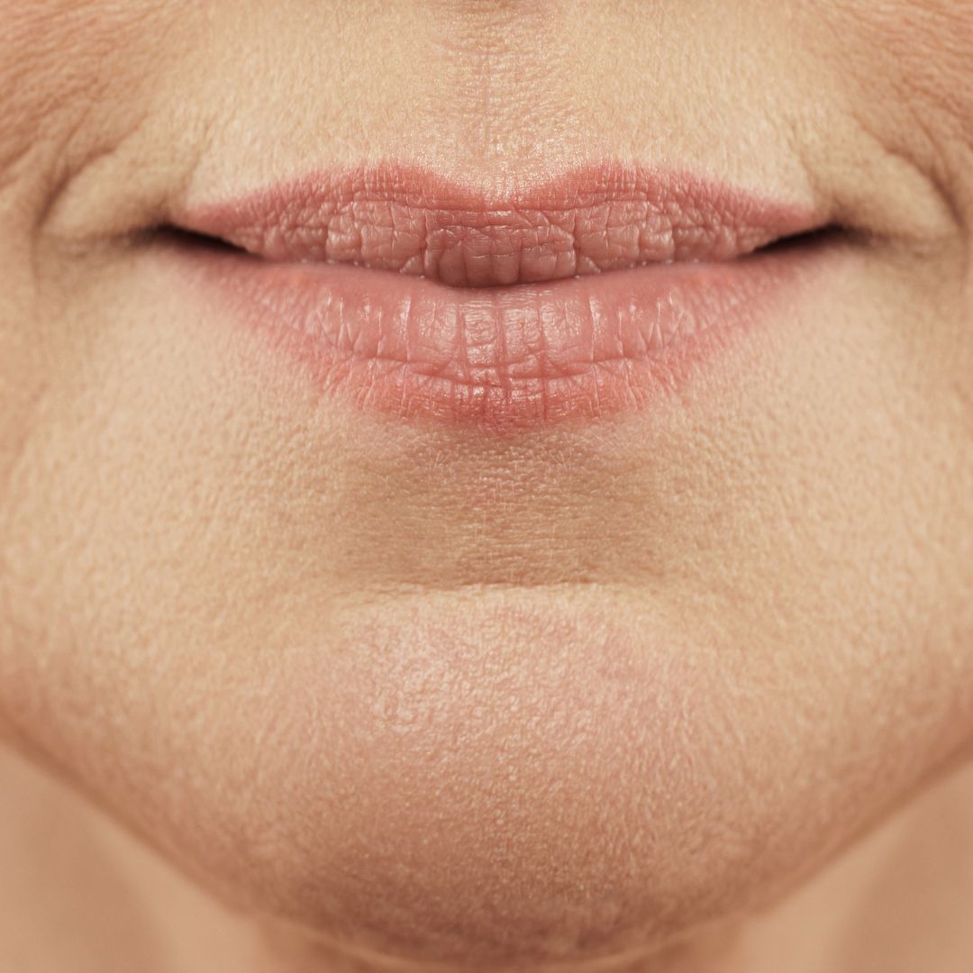 How to Get Rid of Upper Lip Wrinkles & Home Remedies - Utah Facial Plastics