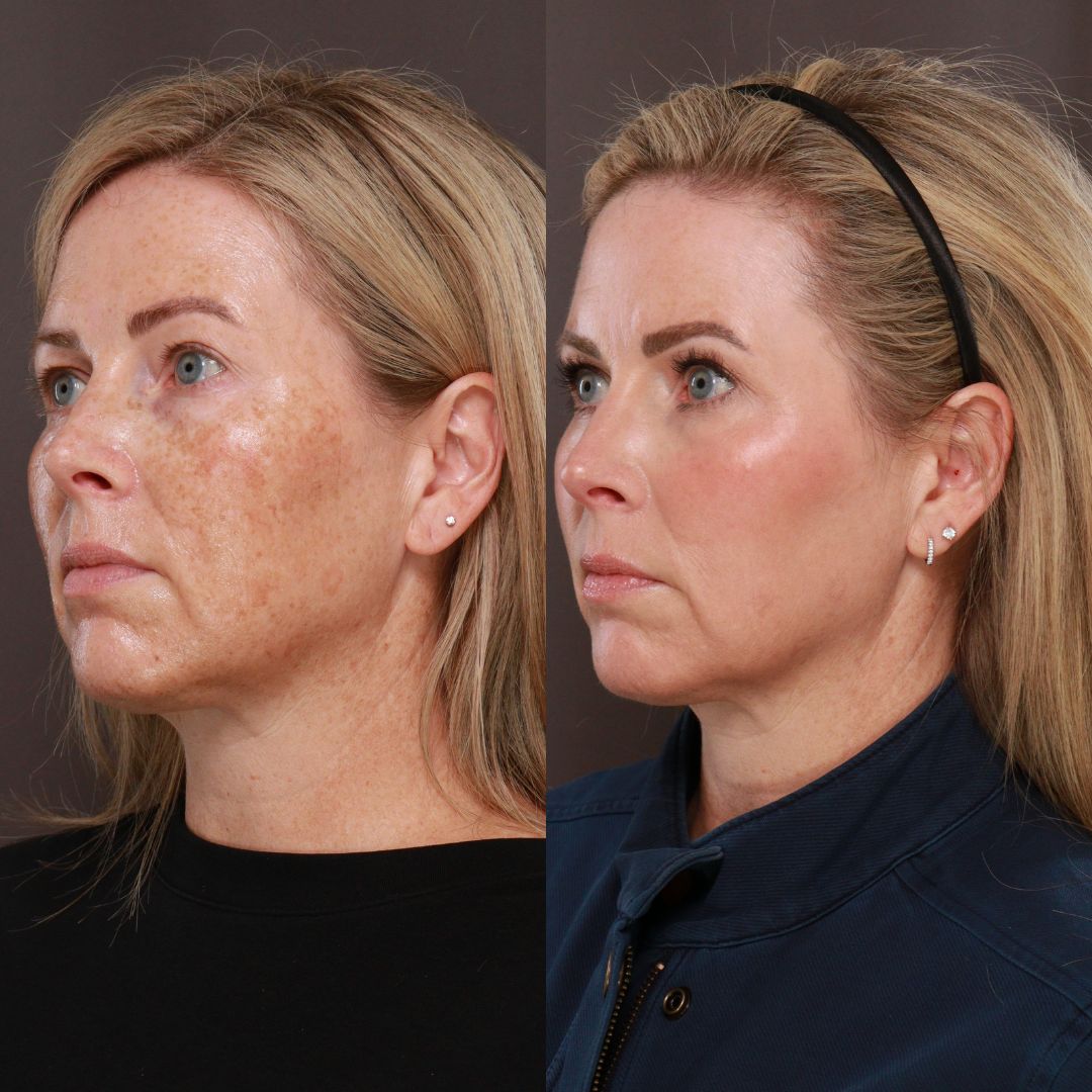 Tratamientos para la piel con luz de banda ancha (BBL) | BBL (SIEMPRE ...