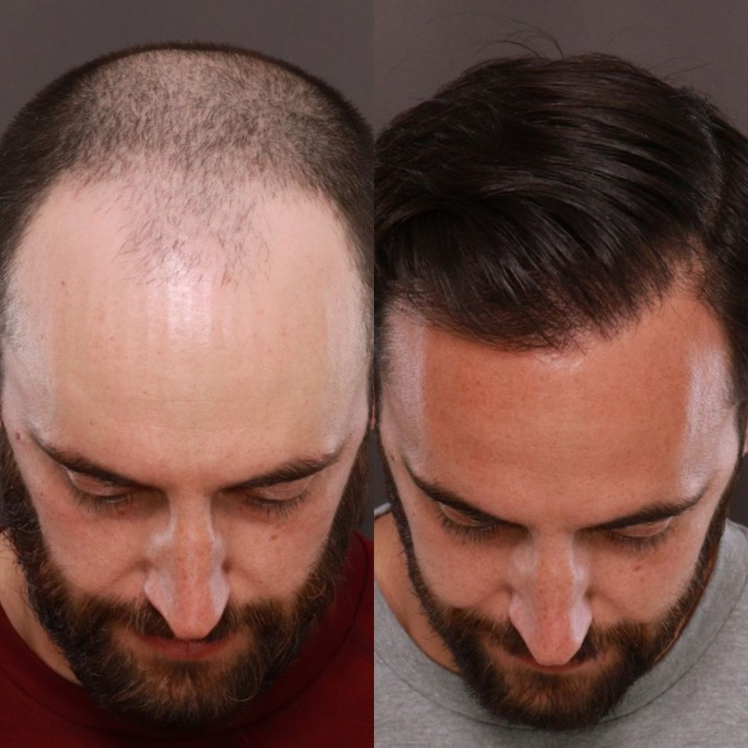 Hair Restoration Salt Lake City UT - Hair Transplant Draper UT