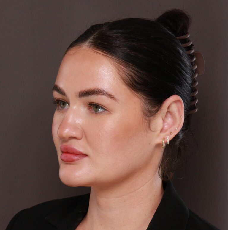 Otoplasty by Dr. Henstrom - Utah Facial Plastics # 68792