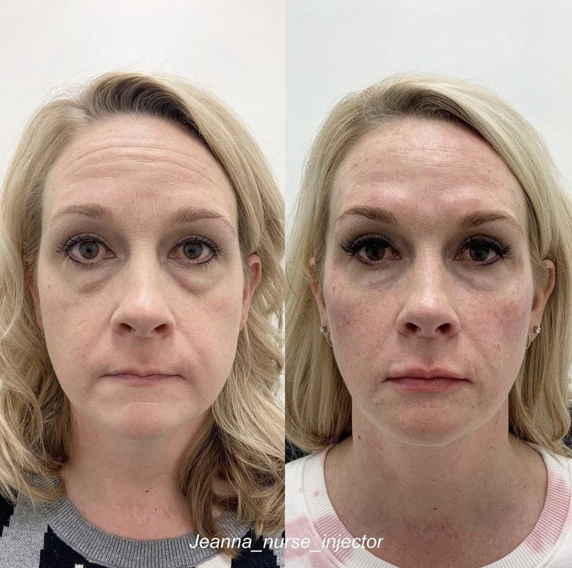 Save Up to $200 on Juvederm Day with UFP! - Utah Facial Plastics