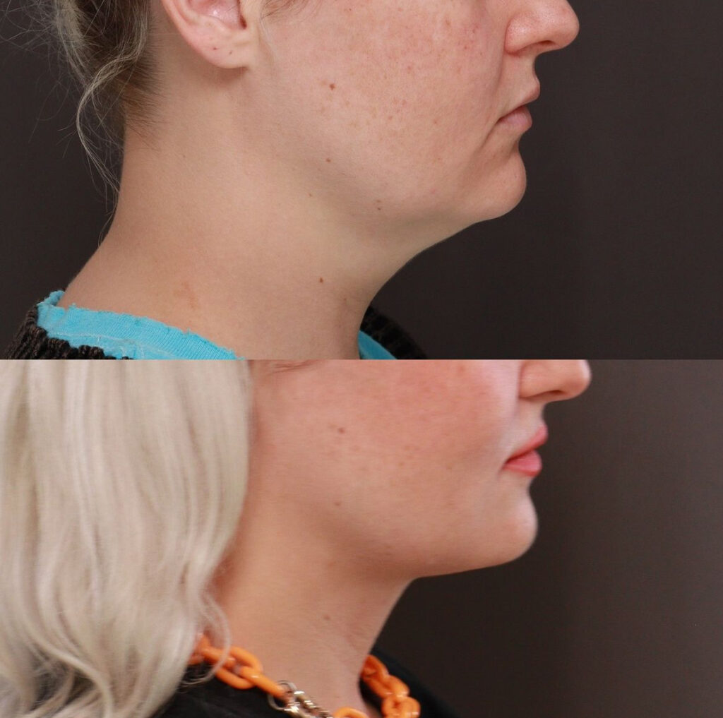 Lower Face Contouring Salt Lake City UT - Utah Facial Plastics