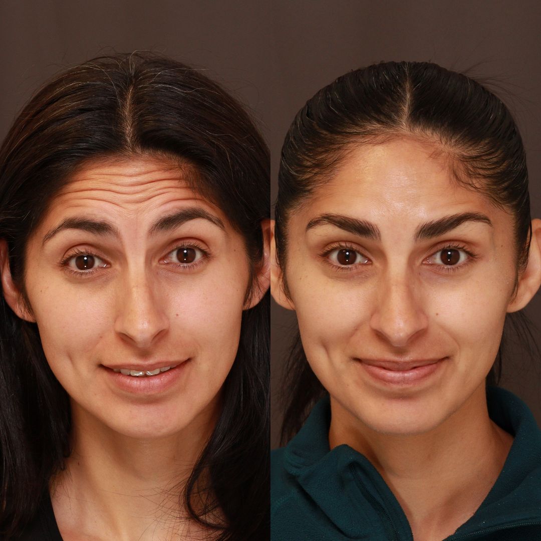BOTOX Salt Lake City - Botox Cosmetic Treatment Utah