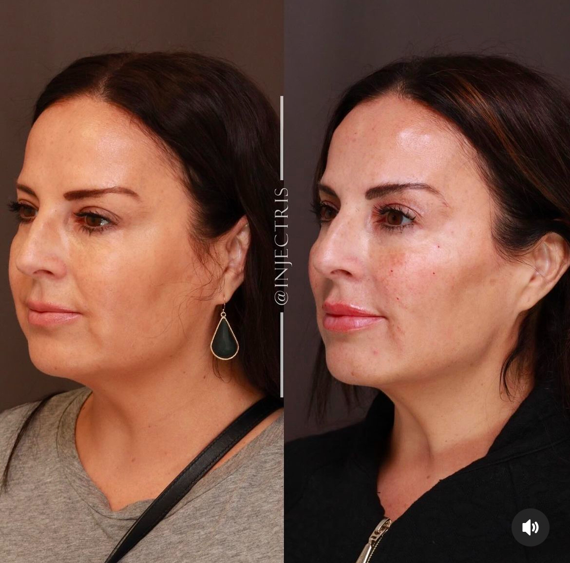 Non-Surgical Facelift Salt Lake City UT - Liquid Facelift in Utah