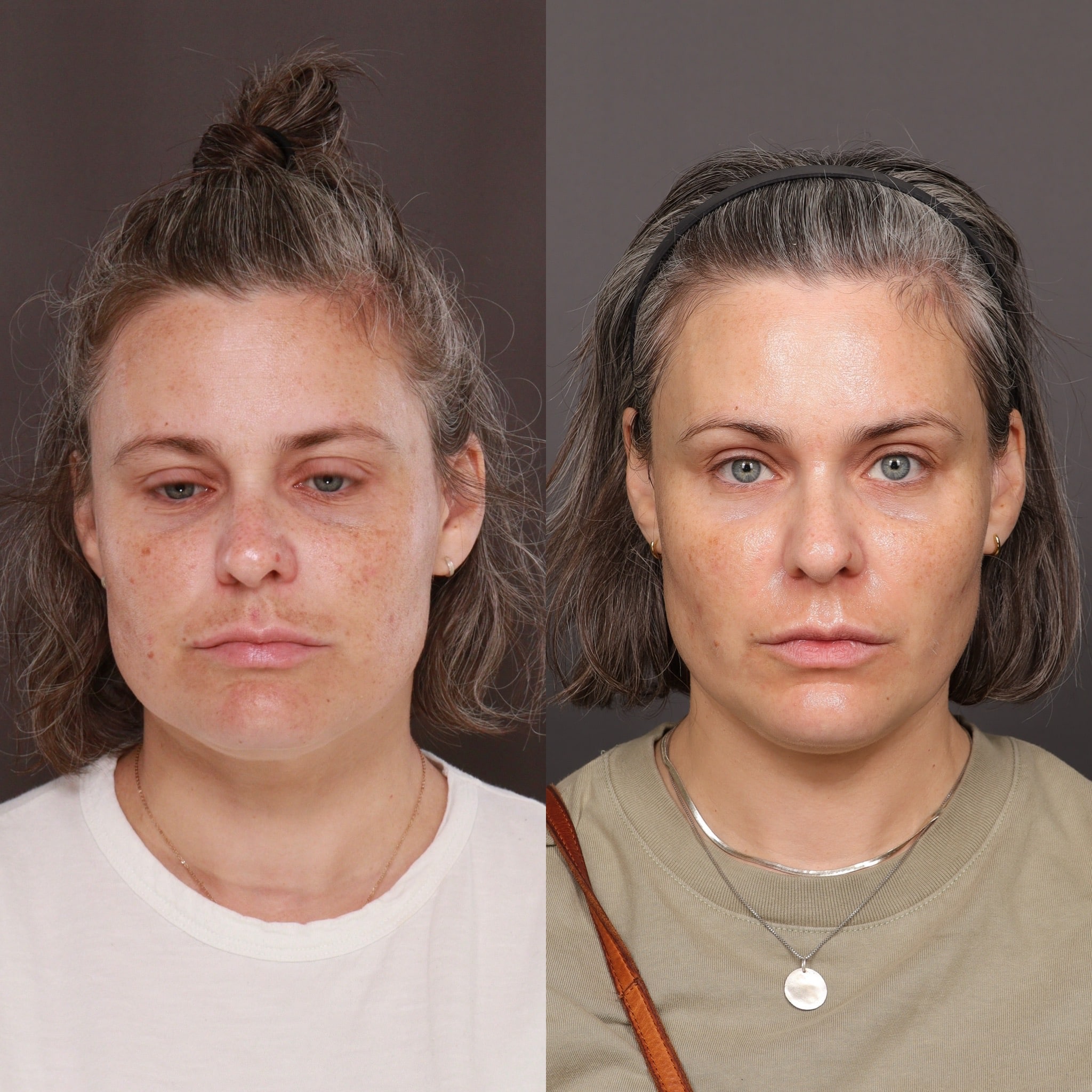 Does Moxi Laser Hurt Understanding Pain During Treatment Utah Facial Does Moxi Laser Hurt Understanding Pain During Treatment Utah Facial